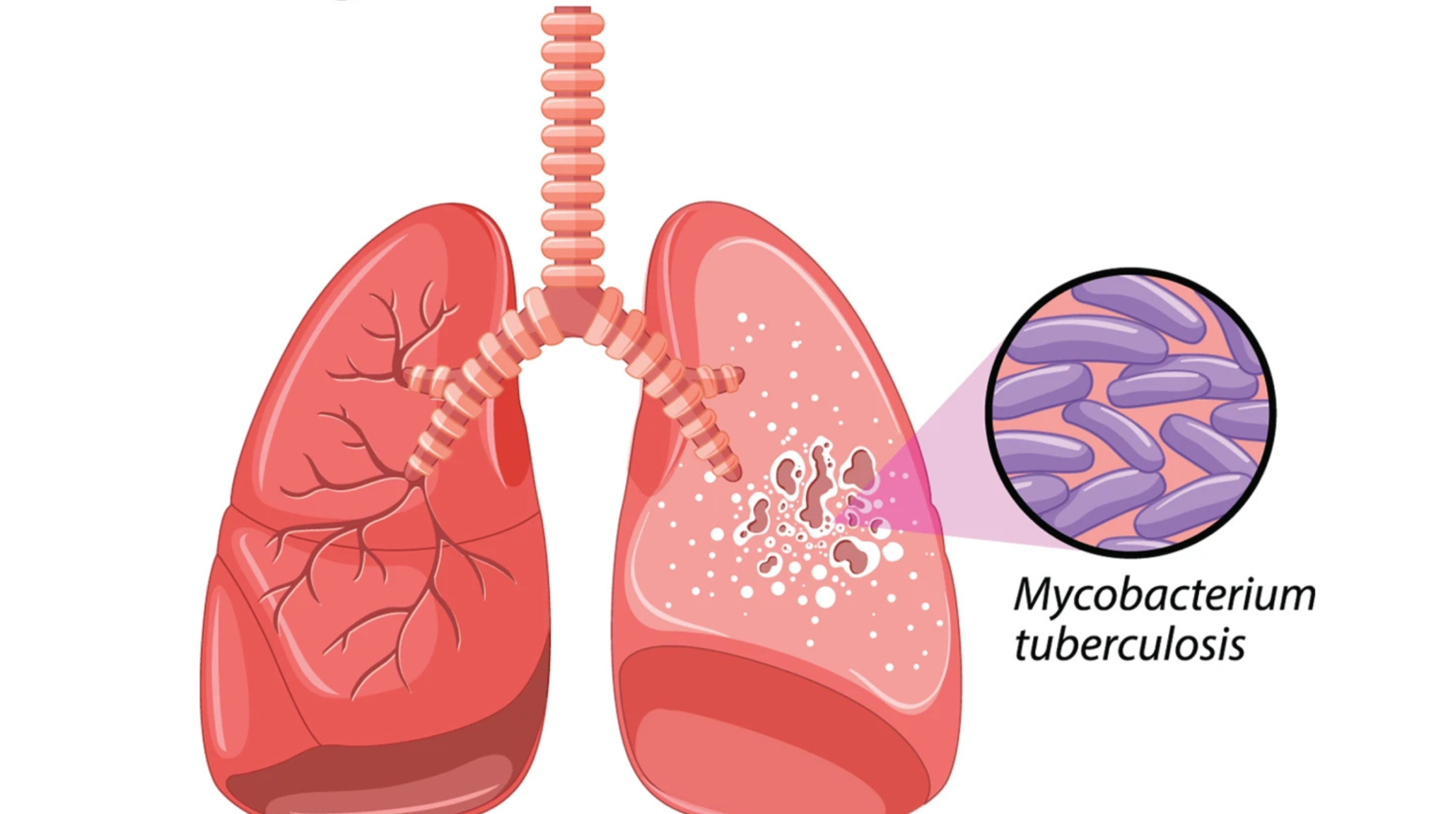 GUTB – How TB affects the kidneys, bladder , reproductive system